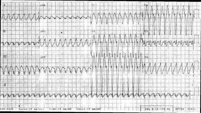 Instructors' Collection ECG: Wide Complex Tachycardia | ECG Guru ... Instructors' Collection ECG: Wide Complex Tachycardia | ECG Guru ...